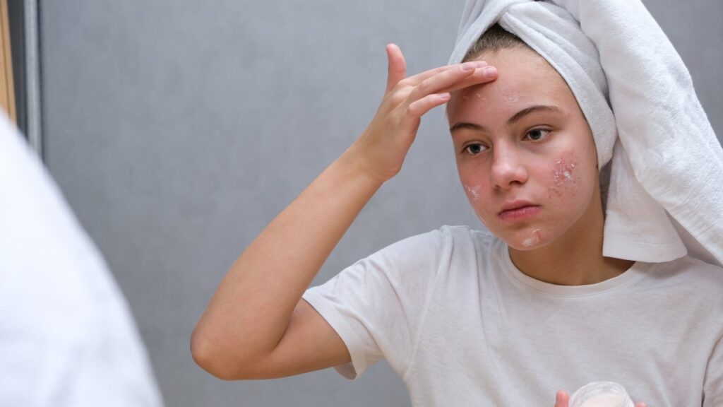 Understanding Hormonal Acne vs. Regular Acne | Hormone Replacement Therapy
